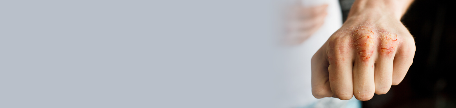 Neurodermatitis What It Is Causes Symptoms And Treatment