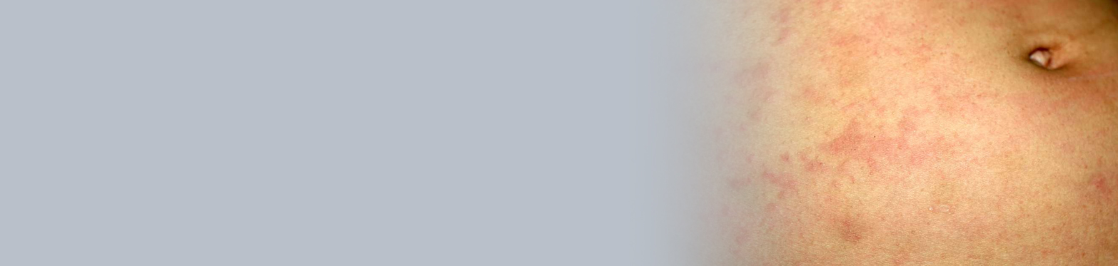 Pityriasis Rosea: Symptoms, Causes, Treatments - Clear Skin Clinic